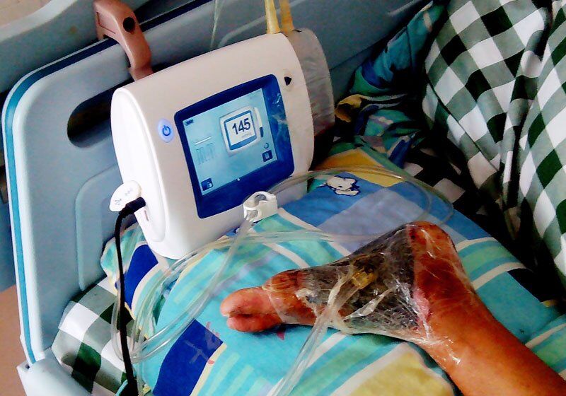How NPWT Helps In Diabetic Foot Ulcers - TenMed