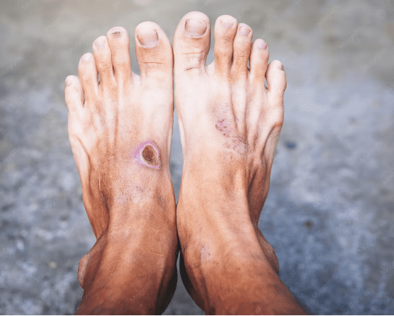 How NPWT Helps In Diabetic Foot Ulcers - TenMed